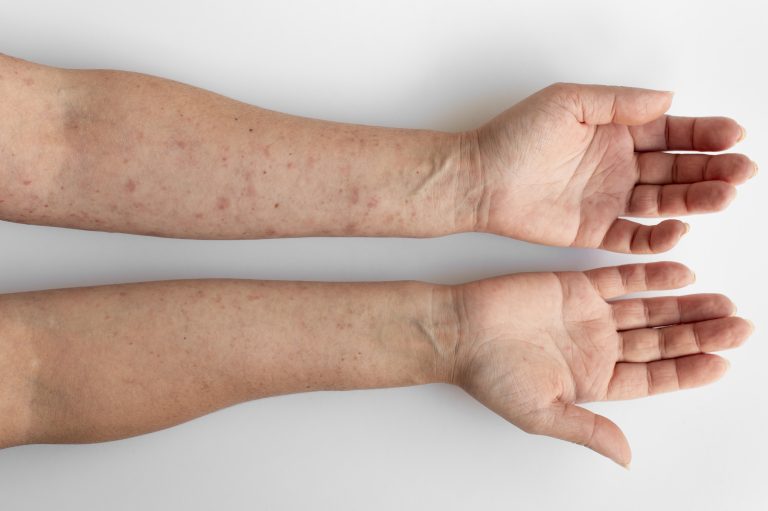 Exploring Semaglutide-Induced Rash: Causes, Prevention, and Treatment ...